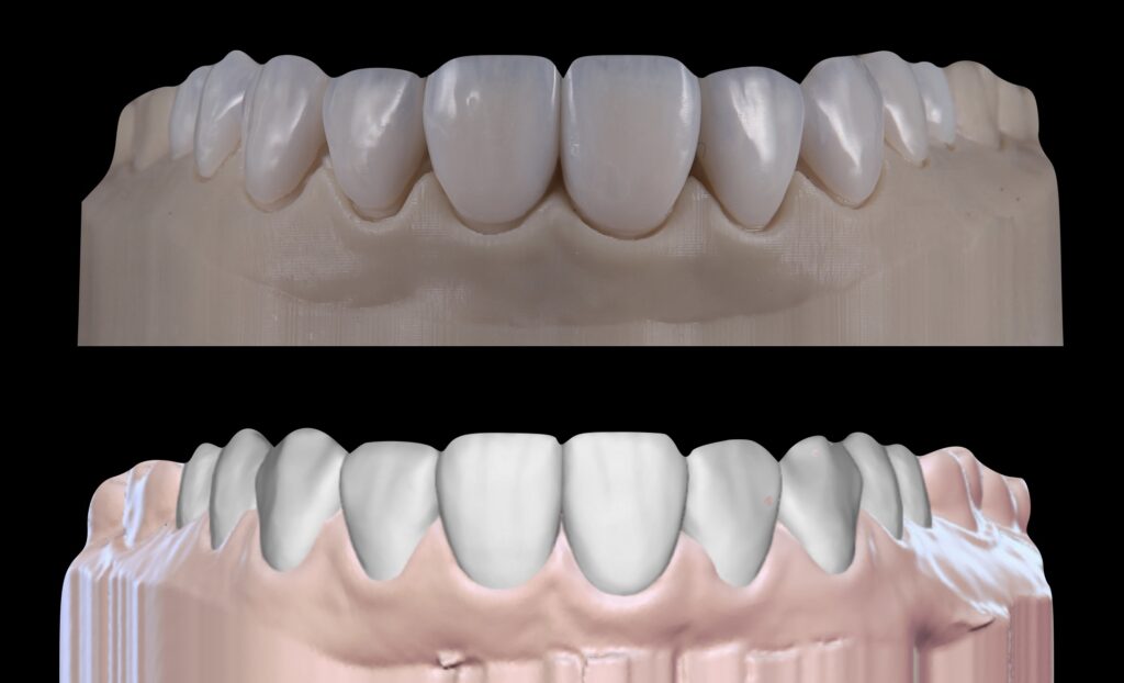 Porcelain Veneers using SmileFy as an in-office 3D Smile Design tool ...