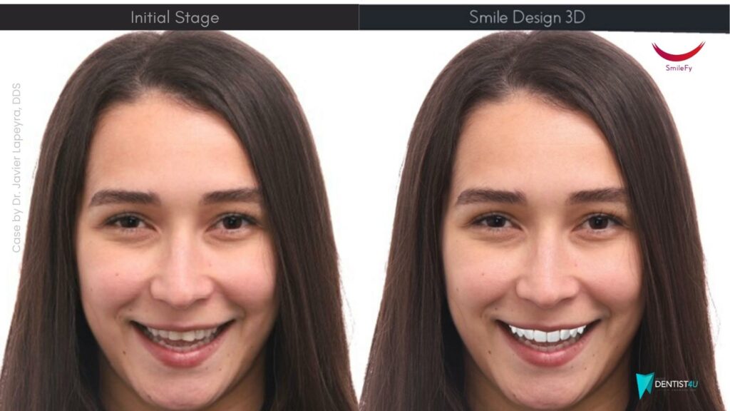 Porcelain Veneers using SmileFy as an in-office 3D Smile Design tool for a transformative ...