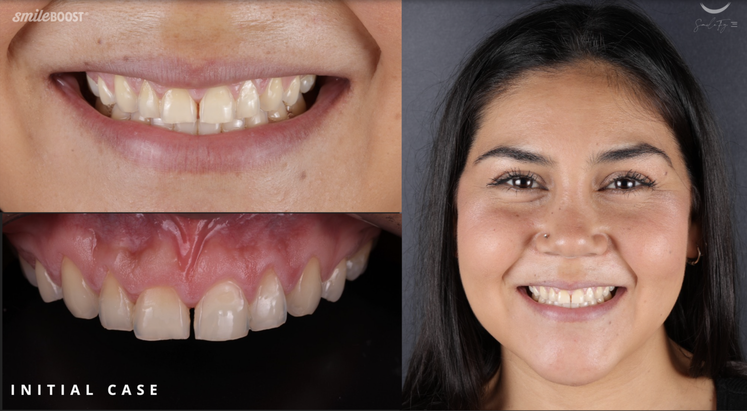 Use of in-office 3D Smile Design for an Open-Method Clinical Prep ...