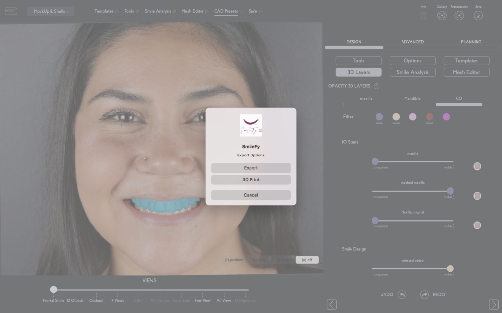 Use of in-office 3D Smile Design for an Open-Method Clinical Prep ...