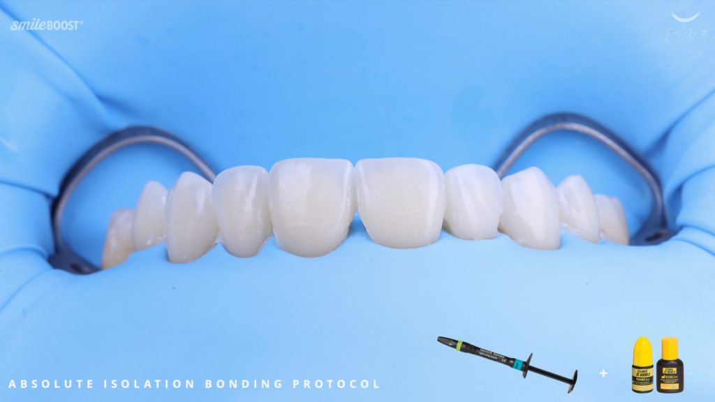 Use of in-office 3D Smile Design for an Open-Method Clinical Prep ...