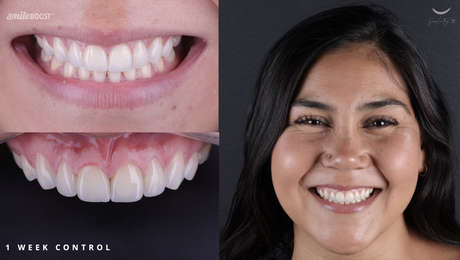 Use of in-office 3D Smile Design for an Open-Method Clinical Prep ...