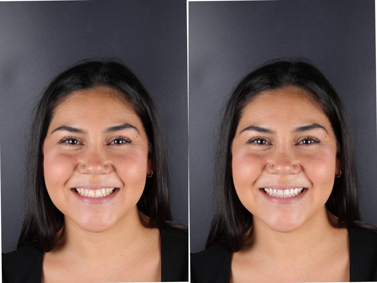 Use of in-office 3D Smile Design for an Open-Method Clinical Prep ...