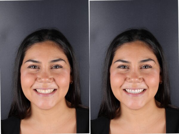 Use of in-office 3D Smile Design for an Open-Method Clinical Prep ...