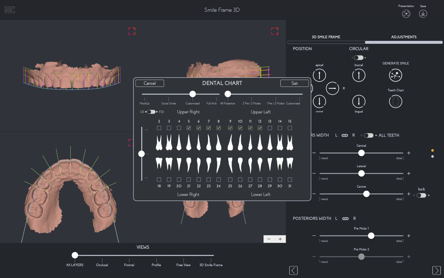 Use of in-office 3D Smile Design for an Open-Method Clinical Prep ...
