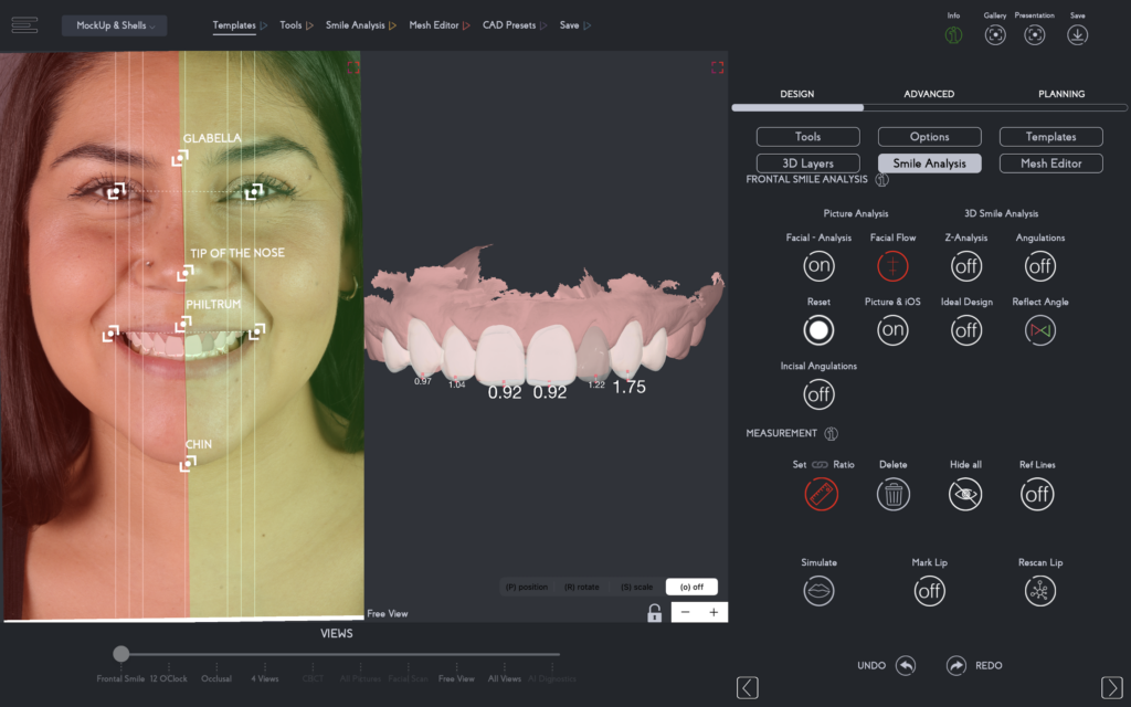 Use of in-office 3D Smile Design for an Open-Method Clinical Prep ...