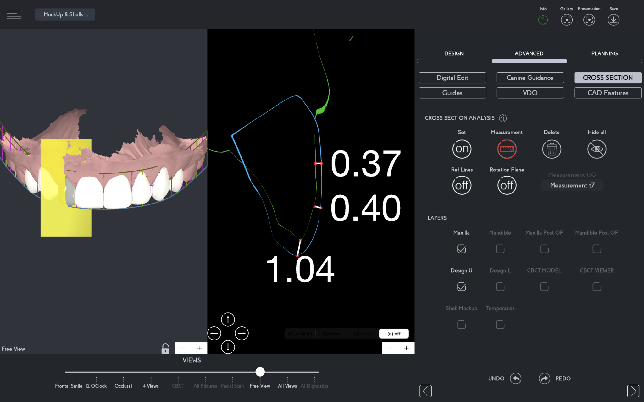 Use of in-office 3D Smile Design for an Open-Method Clinical Prep ...