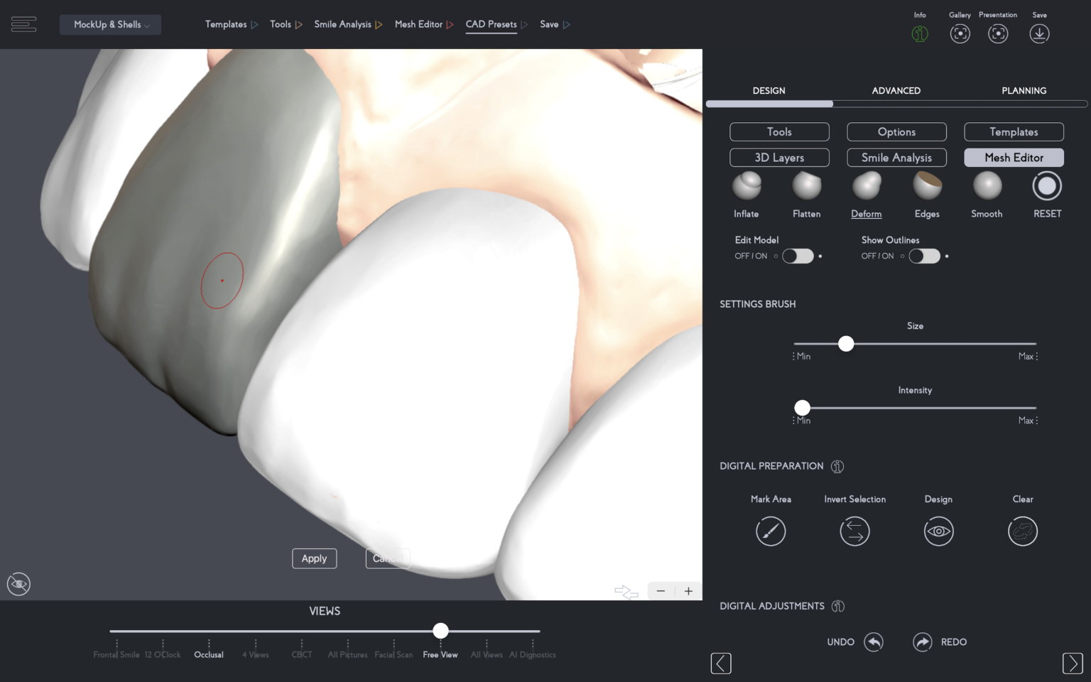 Use of in-office 3D Smile Design for an Open-Method Clinical Prep ...