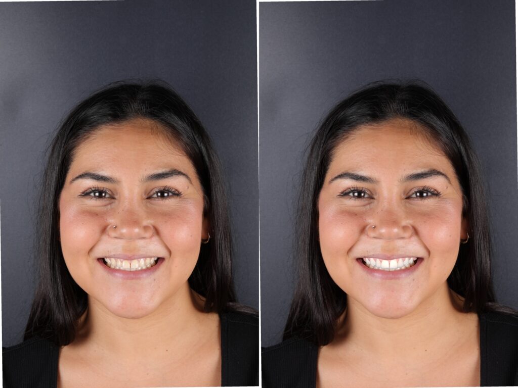 Use of in-office 3D Smile Design for an Open-Method Clinical Prep ...