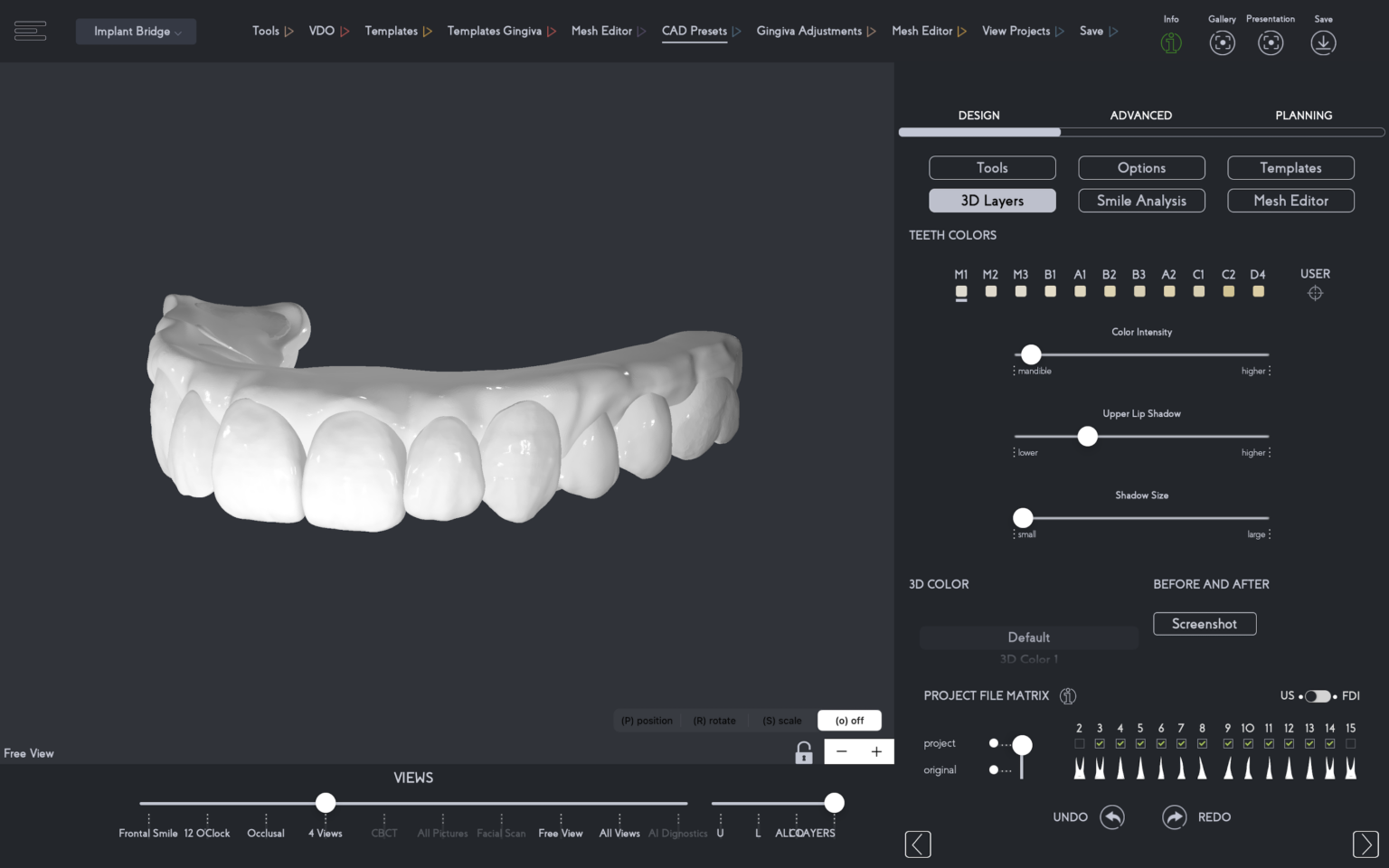 Pre-Surgical Digital Aesthetic Planning for Immediate Loading Screw ...