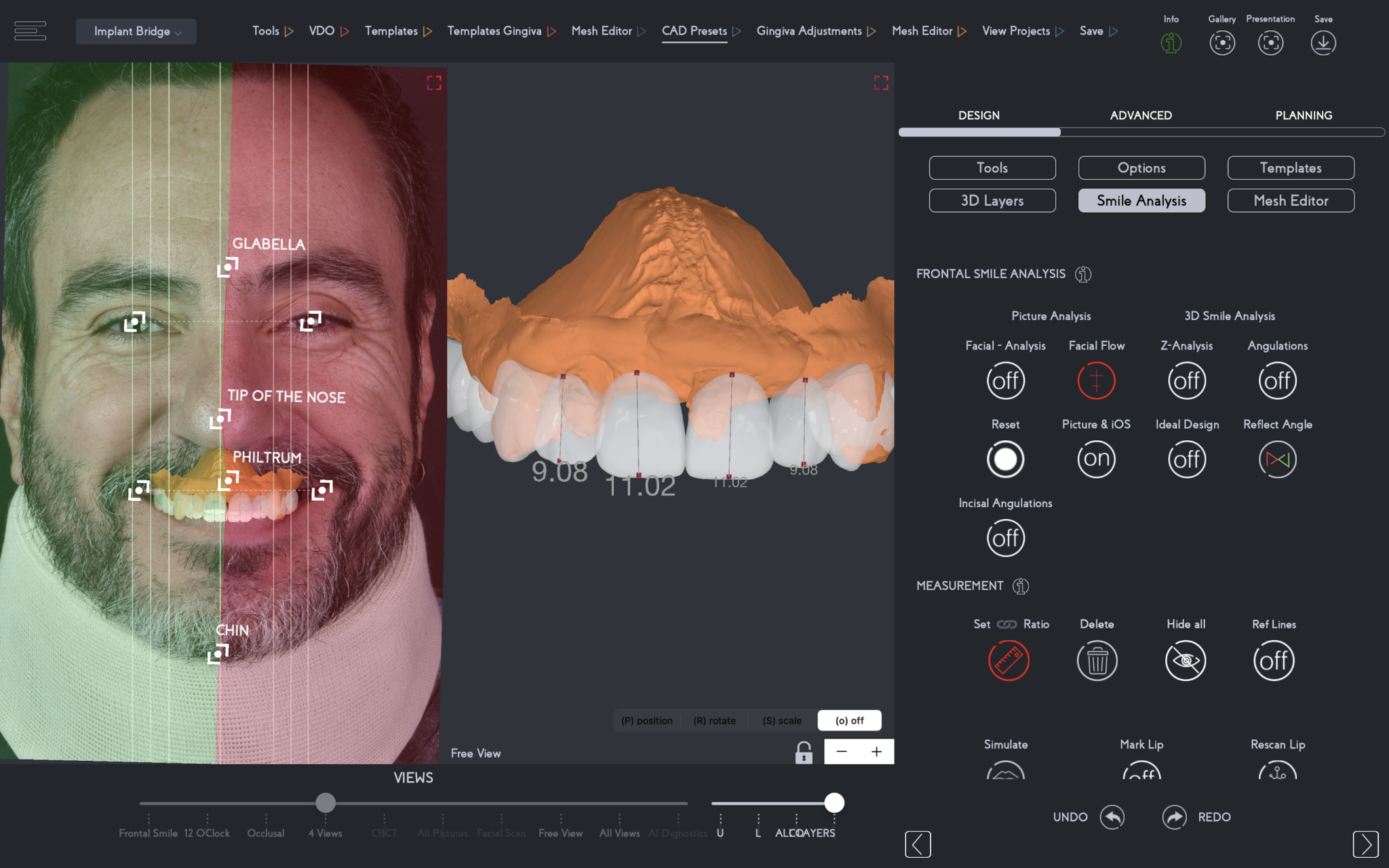 Pre-Surgical Digital Aesthetic Planning for Immediate Loading Screw ...