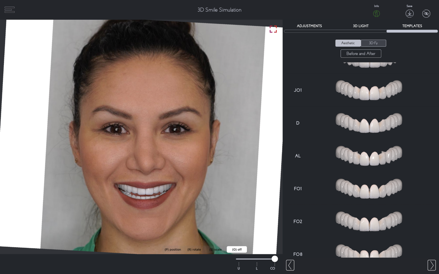 3D A.I. Smile Simulation: How to Perform Smile Harmony in Asymmetrical ...
