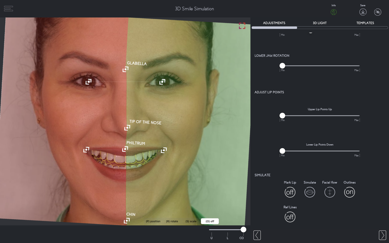 3D A.I. Smile Simulation: How to Perform Smile Harmony in Asymmetrical ...