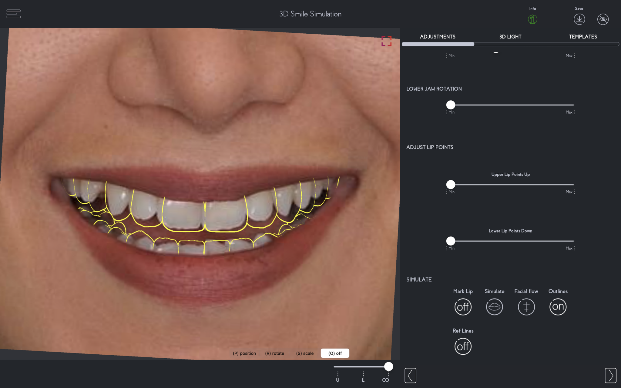 3D A.I. Smile Simulation: How to Perform Smile Harmony in Asymmetrical ...