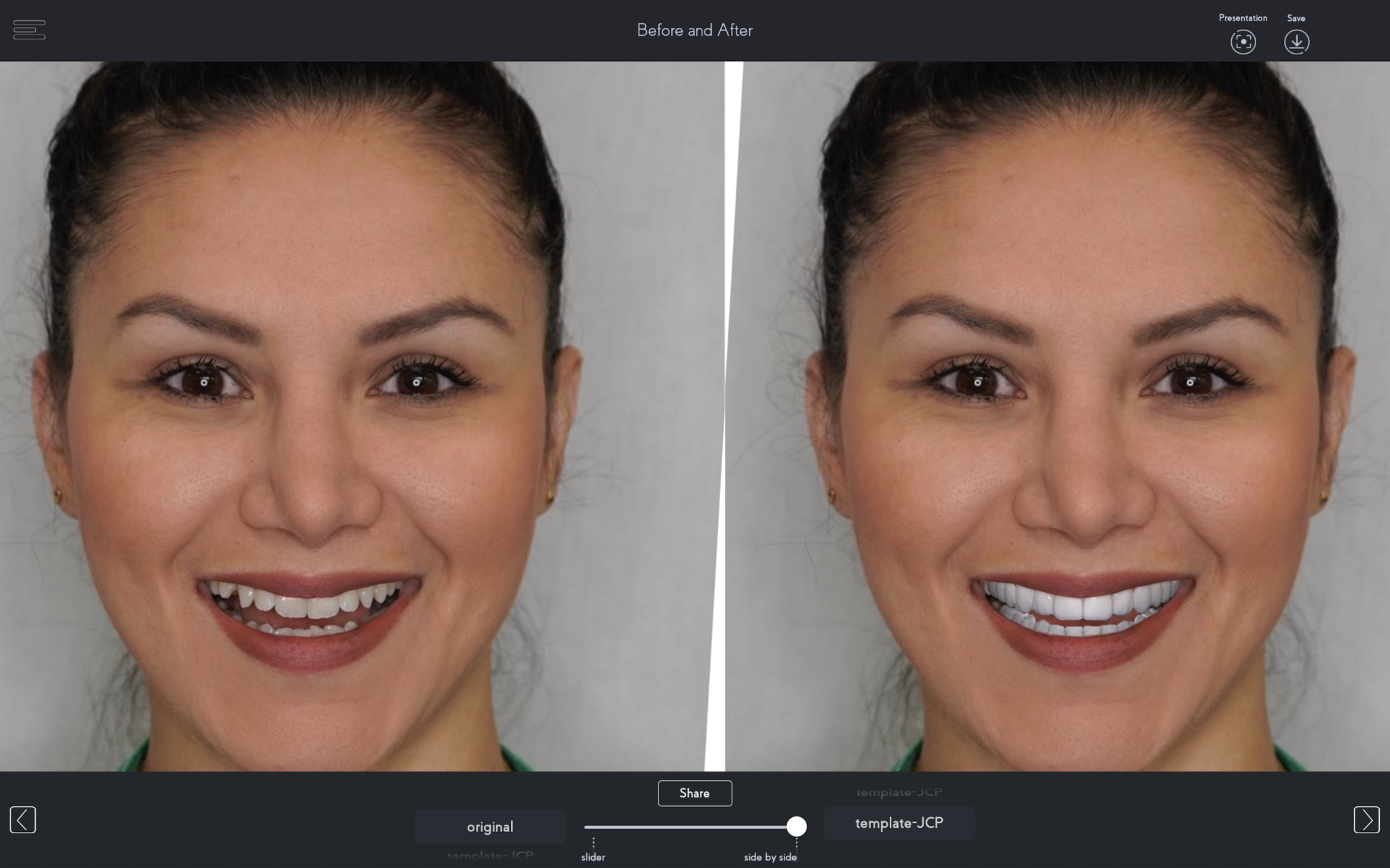 3D A.I. Smile Simulation: How to Perform Smile Harmony in Asymmetrical ...