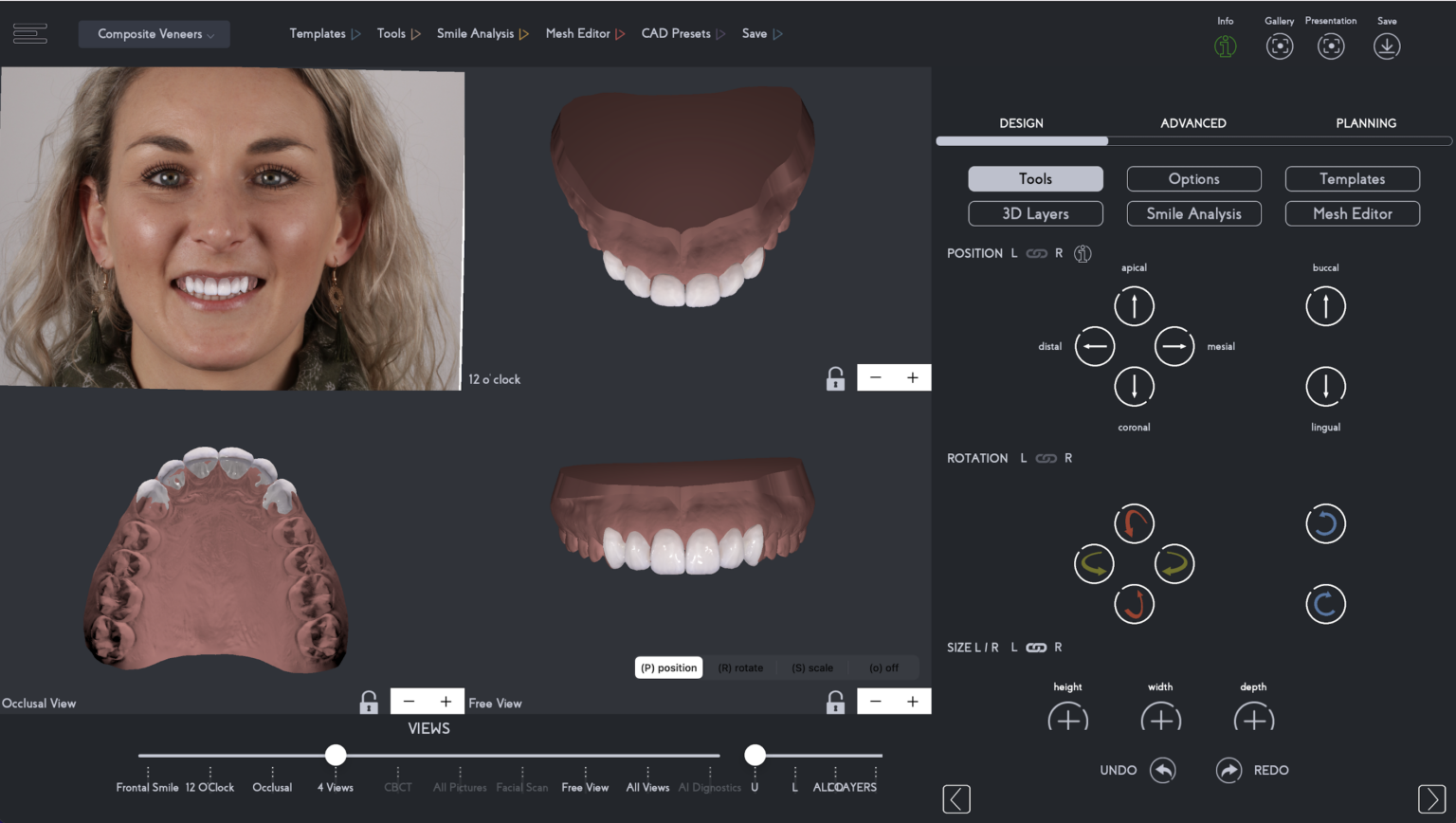 3D Design and Perform of Crown-Lengthening & Injectable Composite in 4 ...