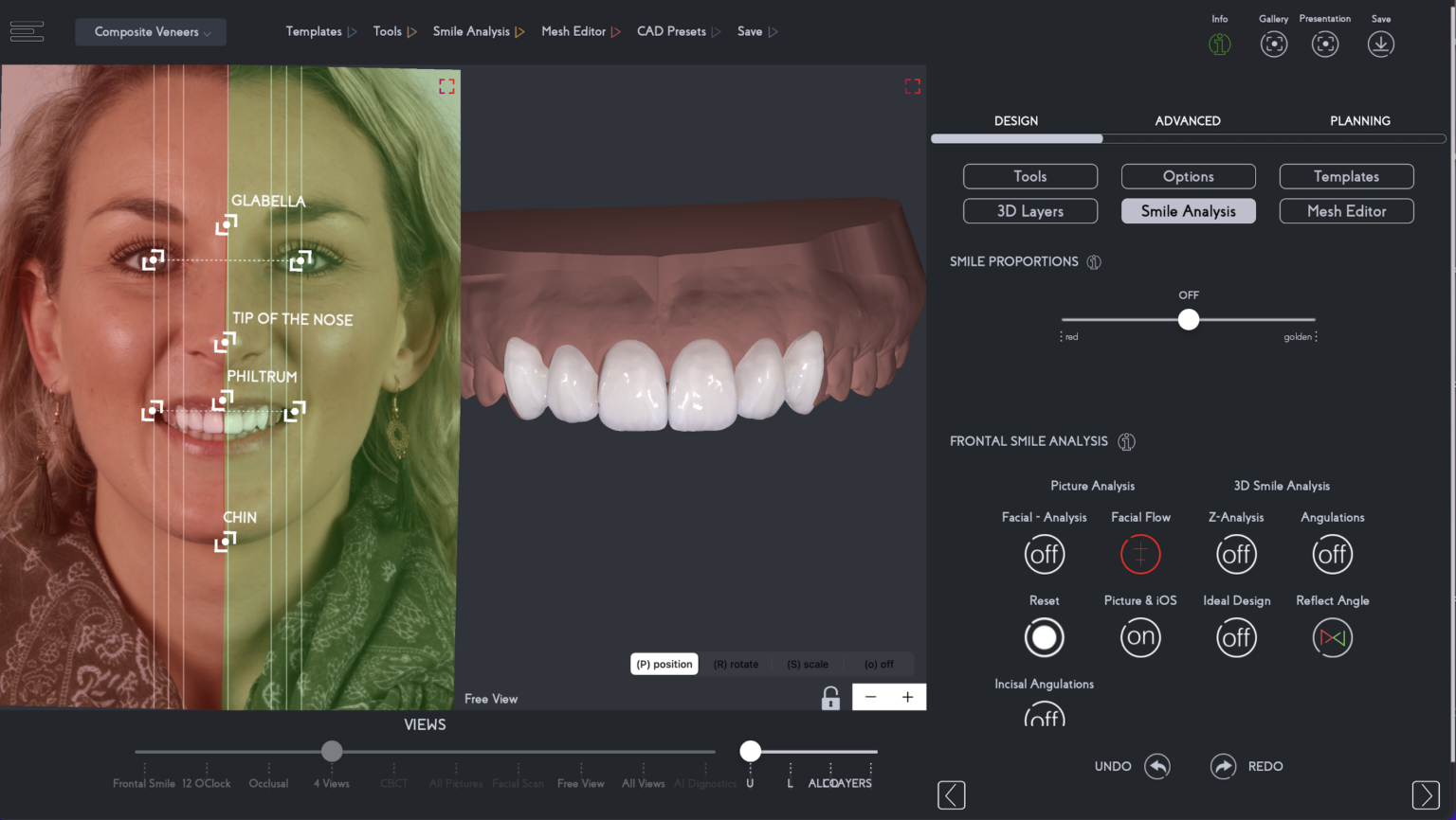 3D Design and Perform of Crown-Lengthening & Injectable Composite in 4-Stages | SmileFy