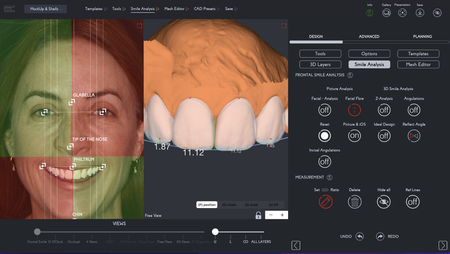 Comprehensive Case Study on Gingival Recontouring and Porcelain Veneers ...