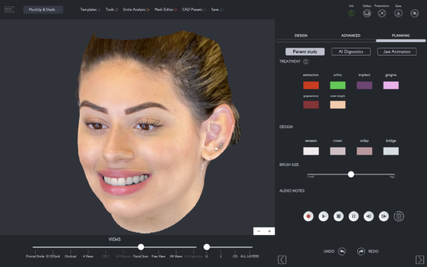 New AI for 3D Smile Design | CAD CAM Dentistry