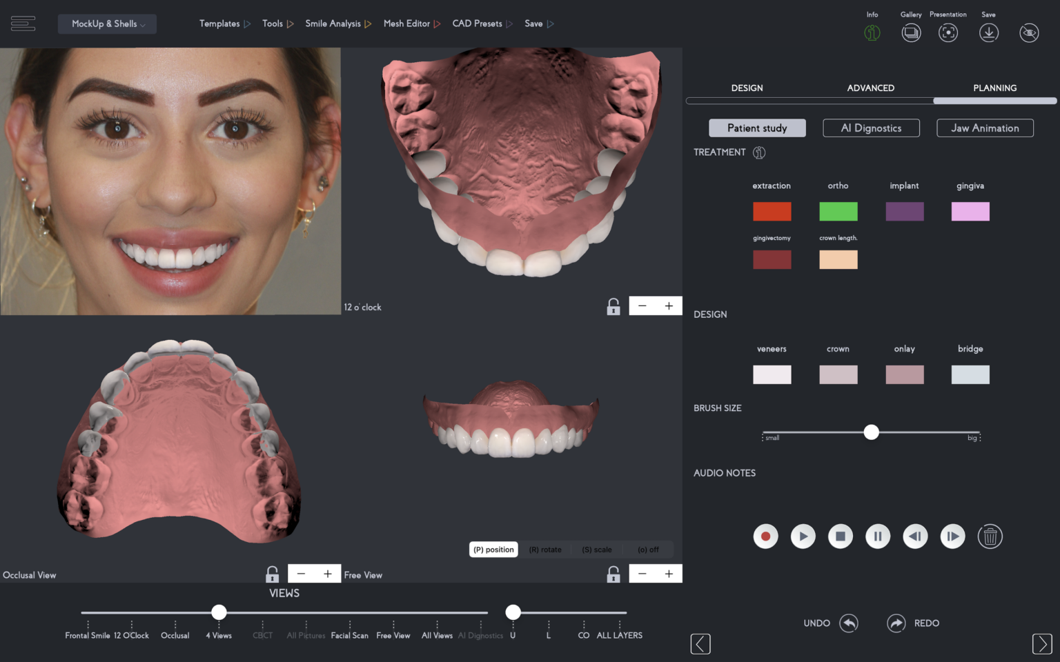 New AI for 3D Smile Design | CAD CAM Dentistry