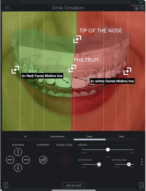 Perception of Smile Harmony in Asymmetrical Faces using Smile Design ...
